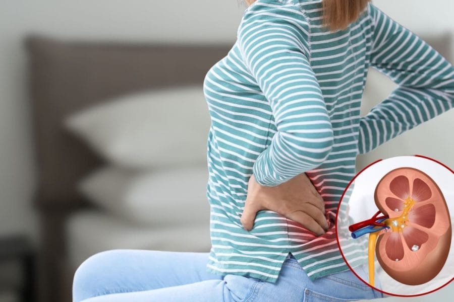 Pietre la rinichi: ghid pentru diagnostic si tratament - NORD
